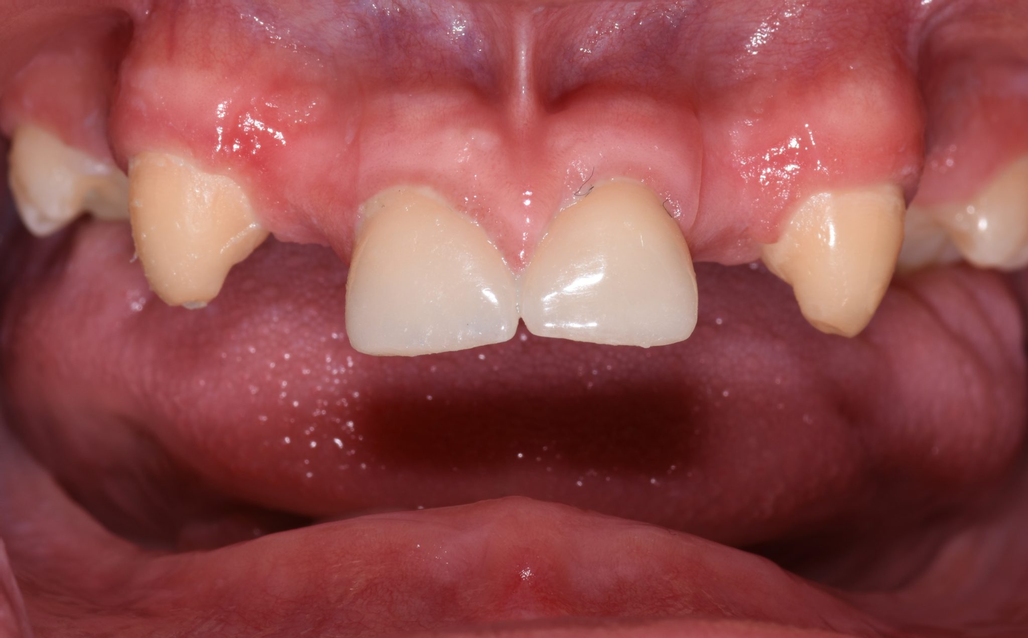 Replacing Congenitally Missing Teeth | Aragon Prosthodontics