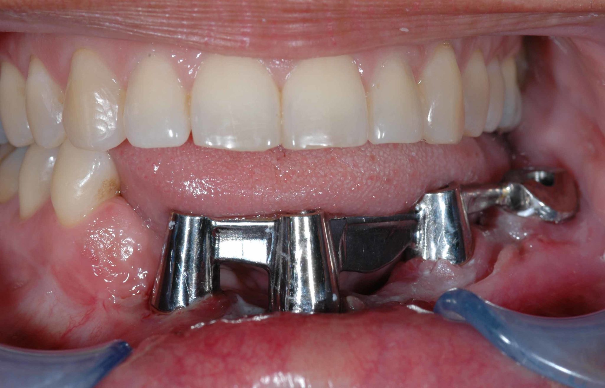 Rehabilitation of Oral Cancer Patients | Aragon Prosthodontics